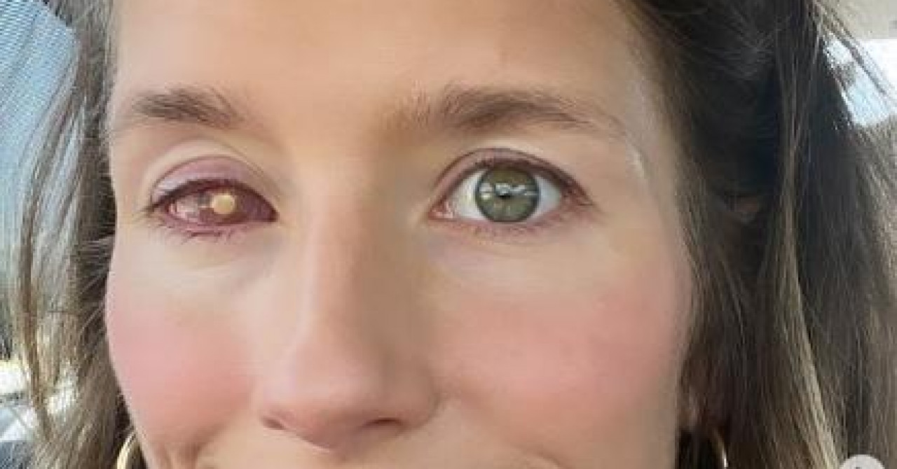 Izgubila vid zbog jedne greške tokom tuširanja